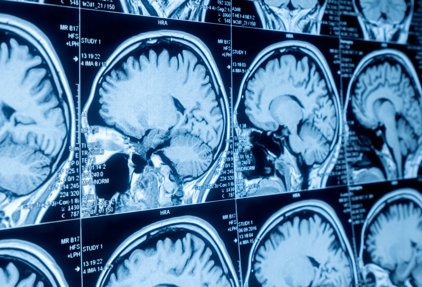 Transcranial Magnetic Stimulation (TMS) for OCD: Does It Work ...